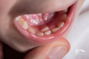 What Are Supernumerary Teeth? Can Braces Fix It?