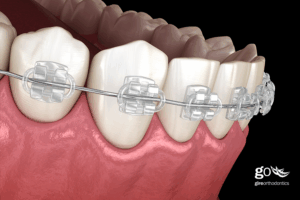 Is It Possible to Get Braces on Only the Bottom Teeth?