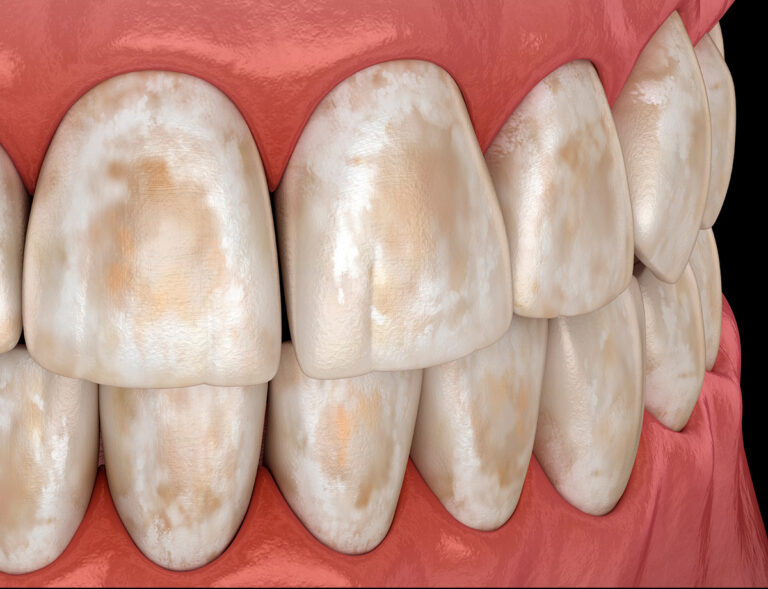 Will Braces Stain My Teeth? Understand, Prevent & Treat Braces Stains