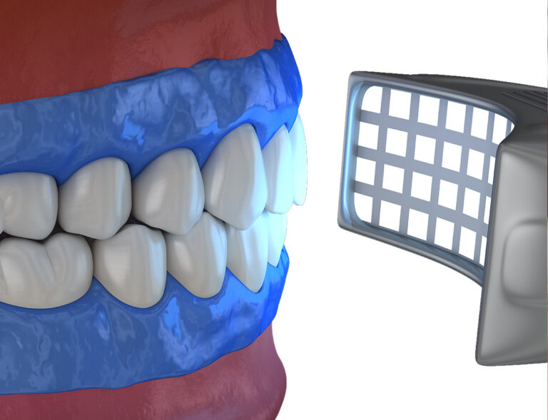Will Braces Stain My Teeth? Understand, Prevent & Treat Braces Stains